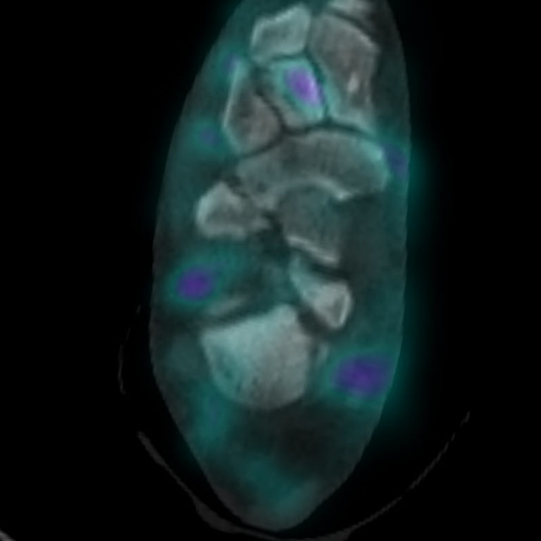 Osteochondrale Läsion des Talus – Nuklearmedizin-Bern.ch | NukMedRad KLG