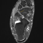 Osteochondrale Läsion des Talus – Nuklearmedizin-Bern.ch | NukMedRad KLG