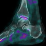 Osteochondrale Läsion des Talus – Nuklearmedizin-Bern.ch | NukMedRad KLG