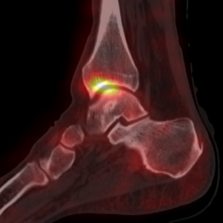 Osteochondrale Läsion des Talus – Nuklearmedizin-Bern.ch | NukMedRad KLG