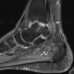 Osteochondrale Läsion des Talus – Nuklearmedizin-Bern.ch | NukMedRad KLG